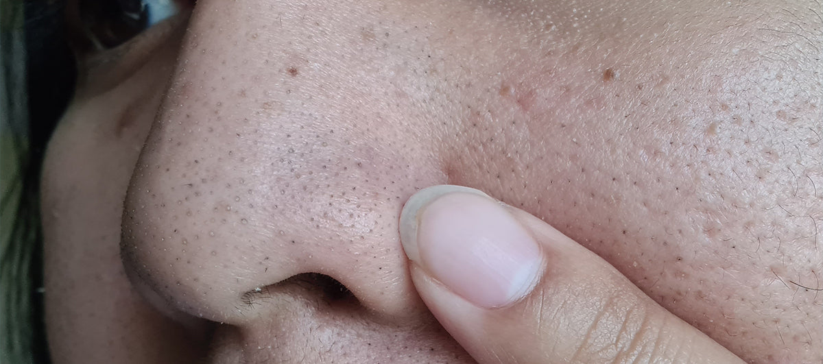 whitehead blackhead