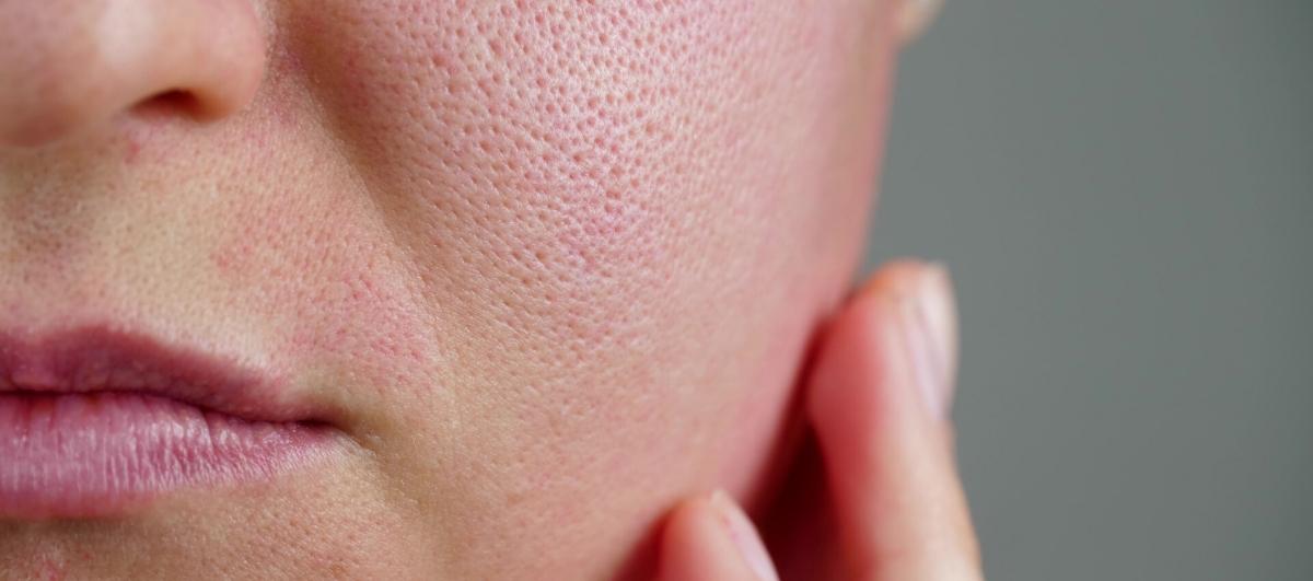 large open pores