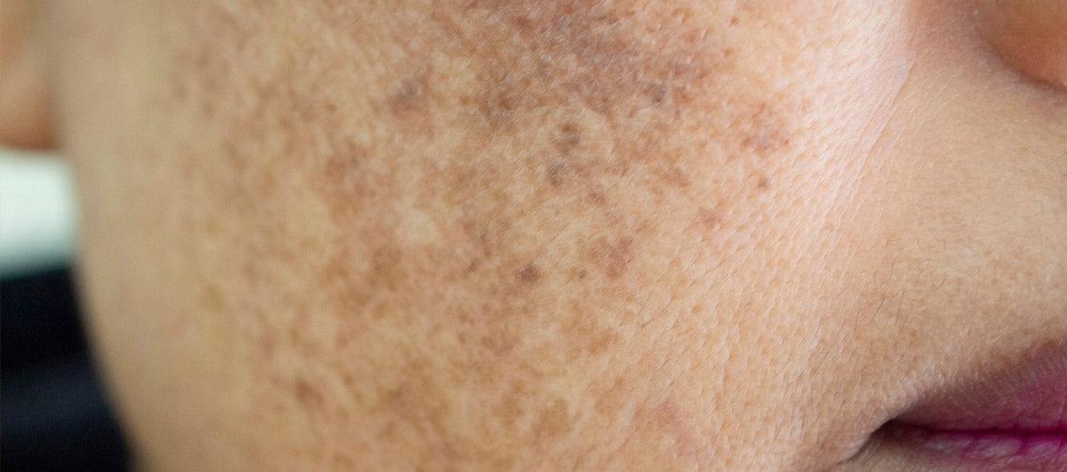 Natural 8 Effective Home Remedies for Pigmentation on Face – Re'equil