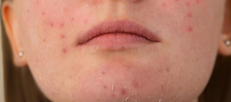 Combatting Issues Associated with Dry Skin and Acne – Re'equil