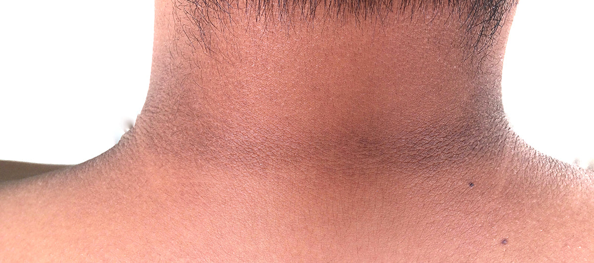 Dark Neck: Everything You Need To Know – Re'equil