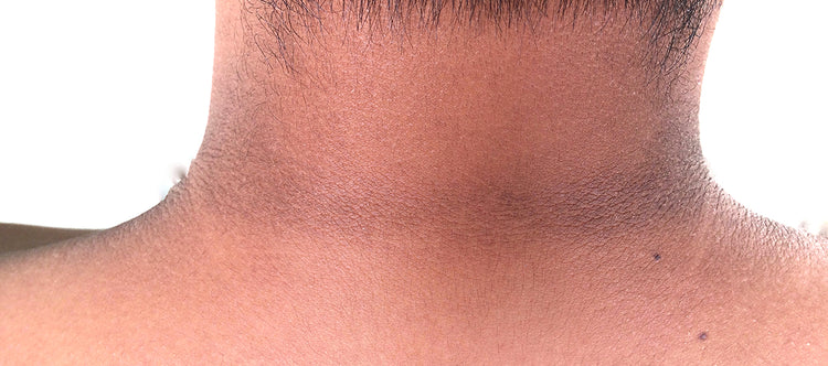 Dark Neck: Everything You Need To Know – Re'equil