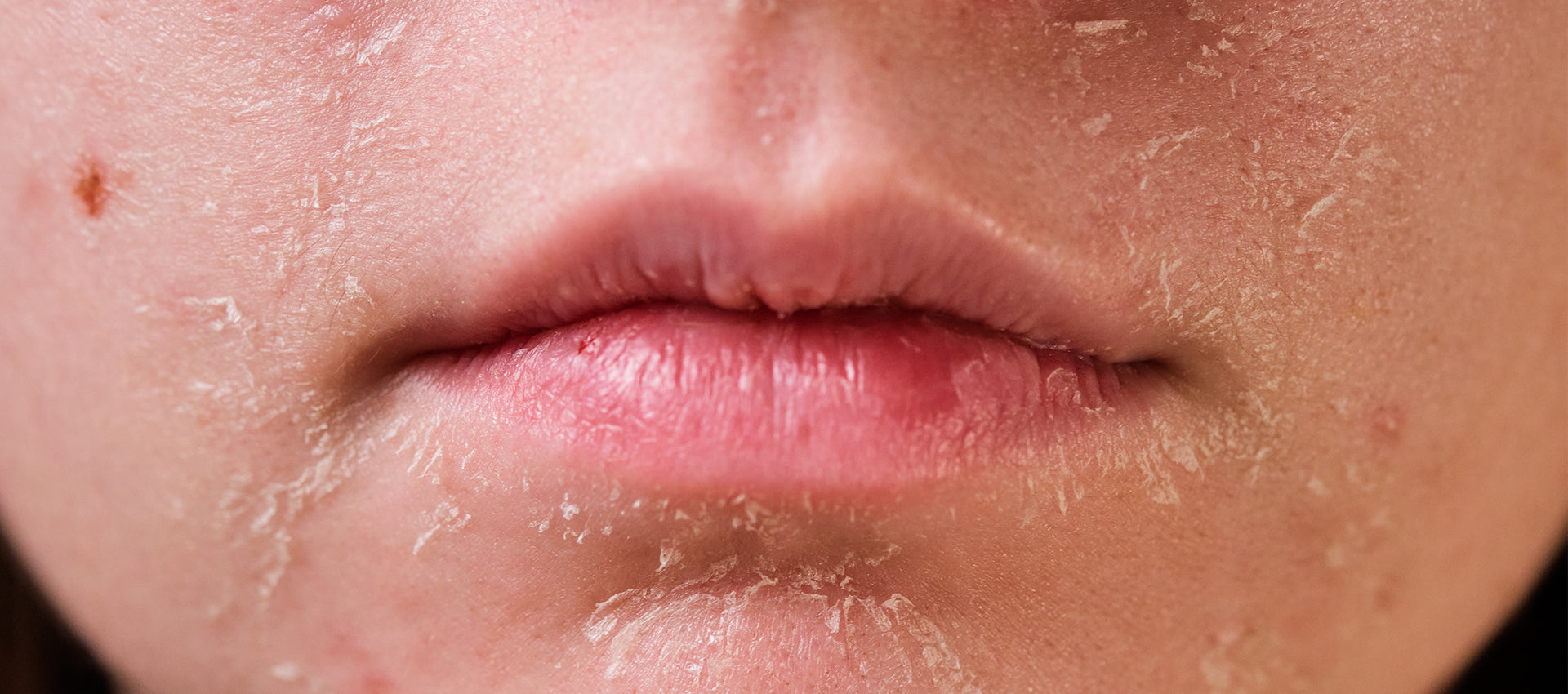 Best Ingredients for Dry Skin Treat Flaky Rough Skin Re equil
