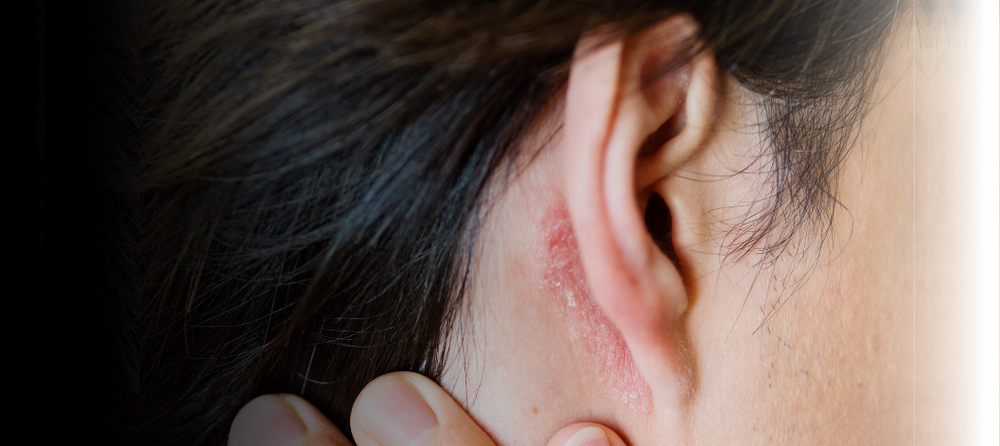 8 most effective ways to treat dry behind your ears – Re'equil