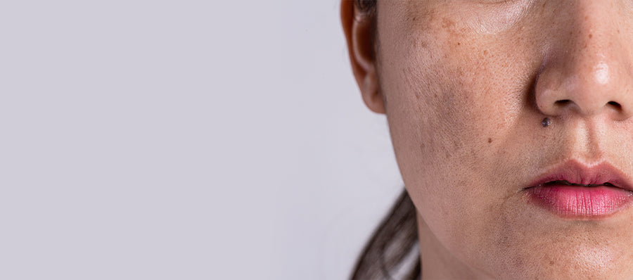 What Are Blemishes? - Causes Of Blemishes – Re'equil