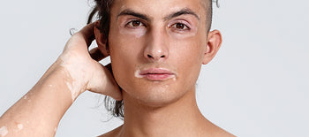 What Causes White Patches On Face? – Re'equil